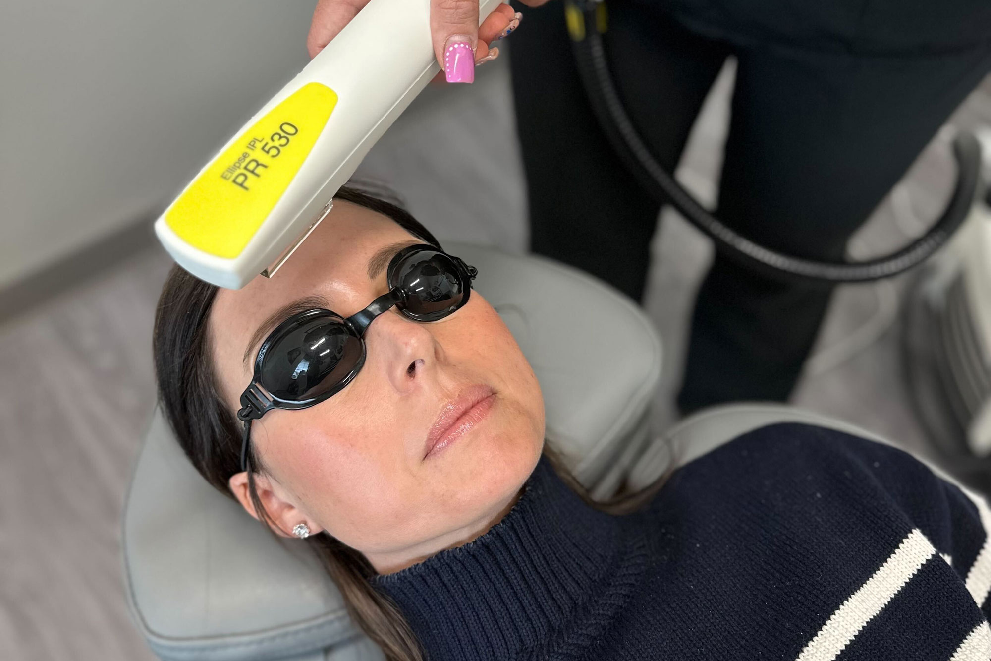 IPL Photofacial in Milwaukee | Mind and Body Medical Spa